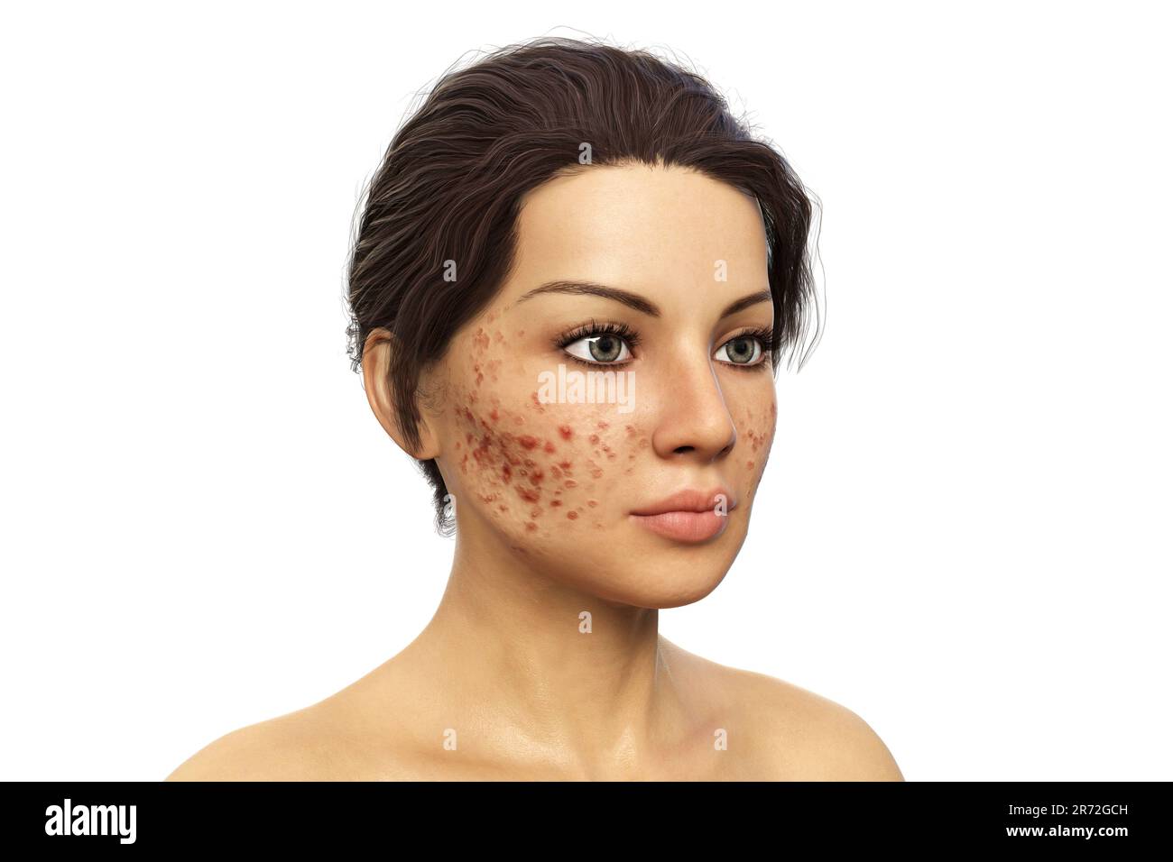 Acne vulgaris on a teenage girl's face, computer illustration. Acne is ...