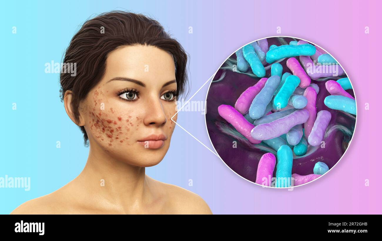 Acne vulgaris on a teenage girl's face and close-up view of bacteria ...