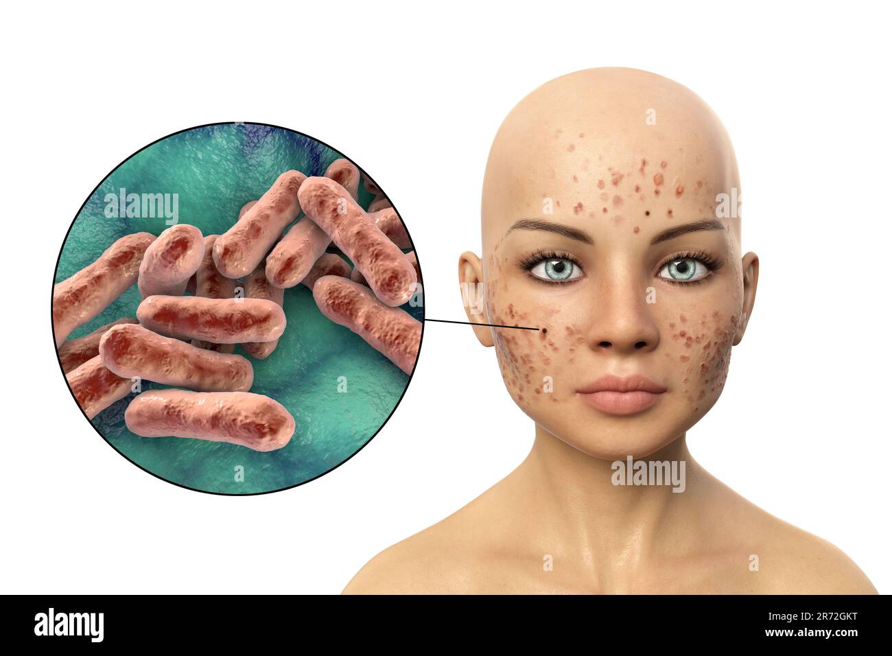 Acne vulgaris on a teenage girl's face and close-up view of bacteria ...