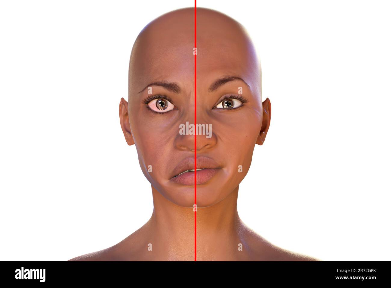 Bell's palsy hi-res stock photography and images - Alamy