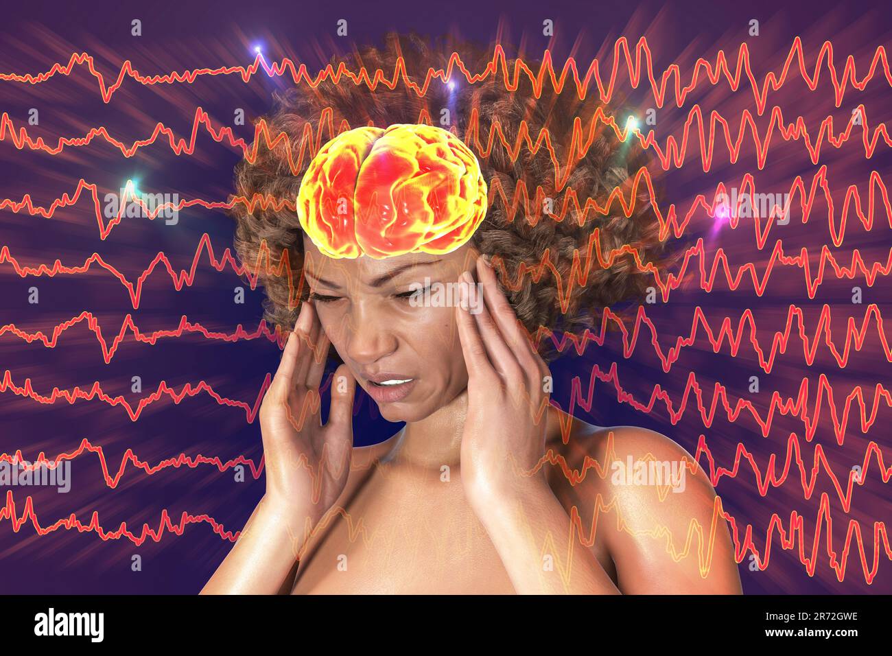 Headache, migraine, computer illustration Stock Photo - Alamy