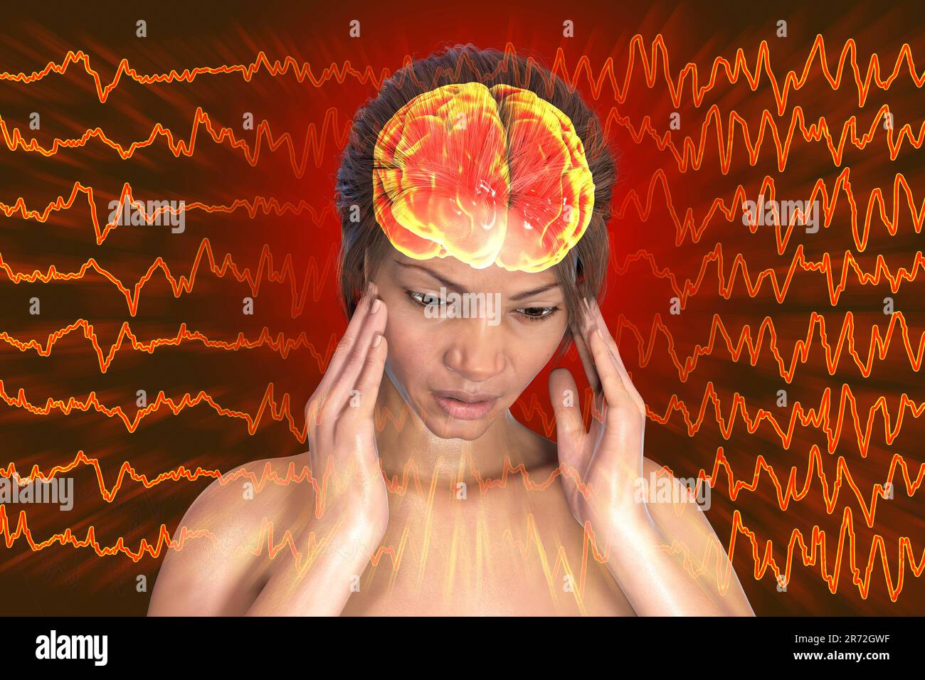 Headache, migraine, computer illustration Stock Photo - Alamy