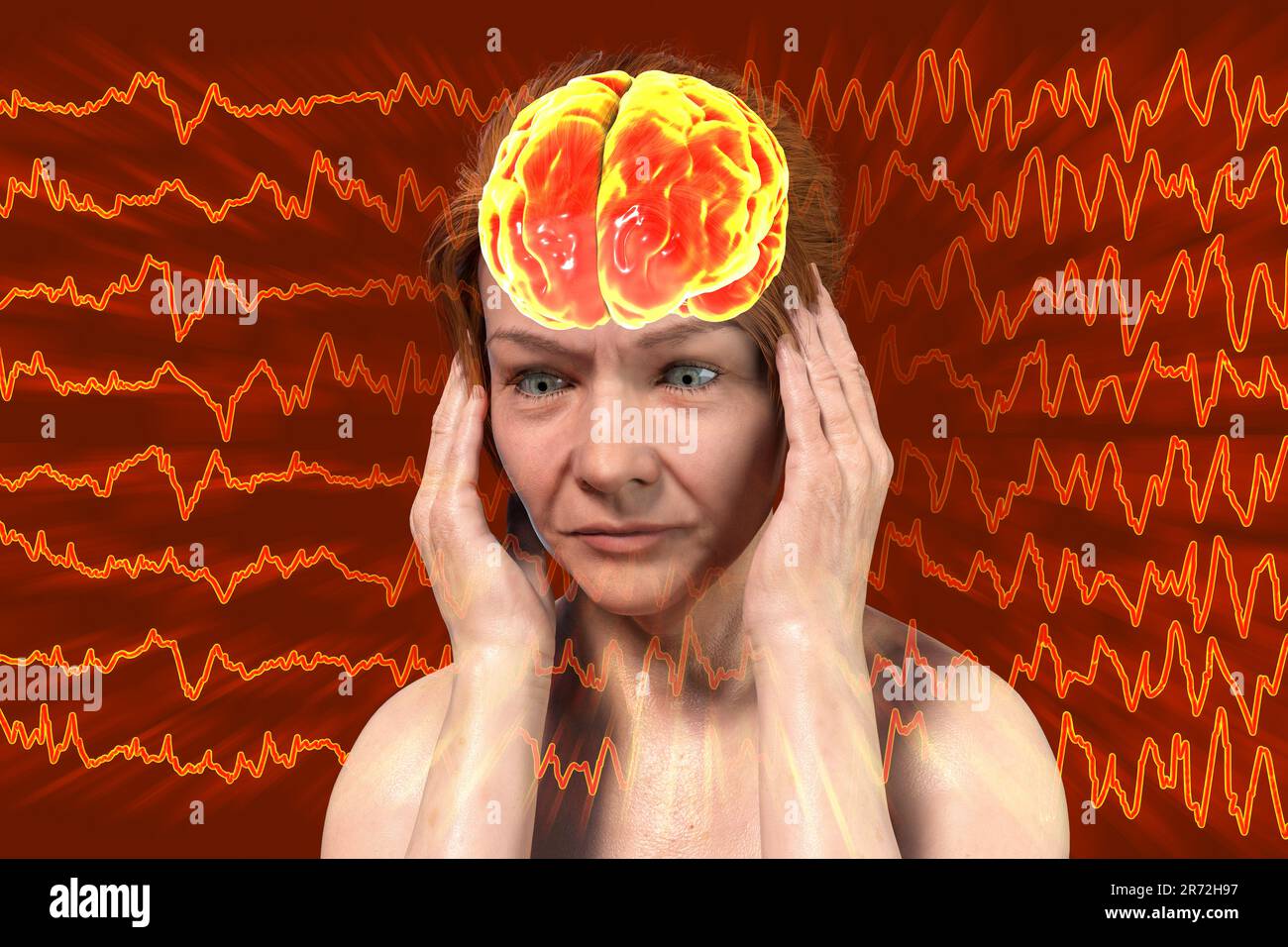 Headache, migraine, computer illustration Stock Photo - Alamy