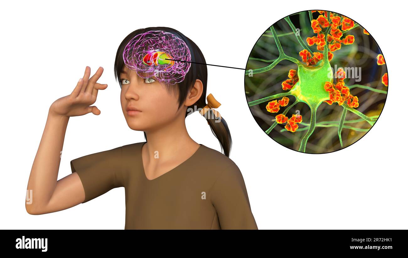 Anti-basal ganglia antibodies (ABGA). Conceptual computer illustration ...