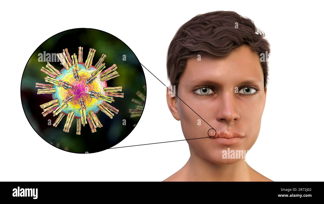 Cold Sore On The Lip Of A Man And Closeup View Of Herpes Simplex Viruses Computer Illustration