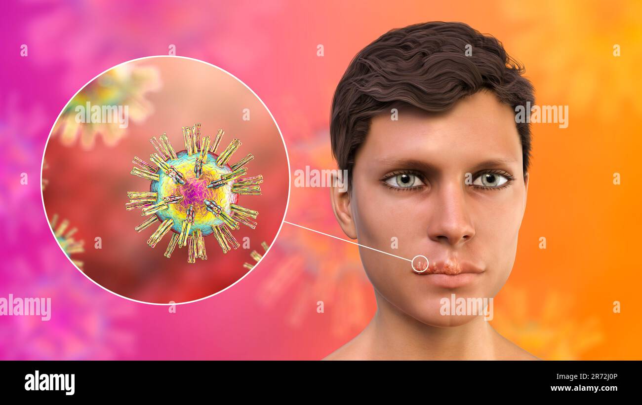 Cold Sore On The Lip Of A Man And Closeup View Of Herpes Simplex Viruses Computer Illustration