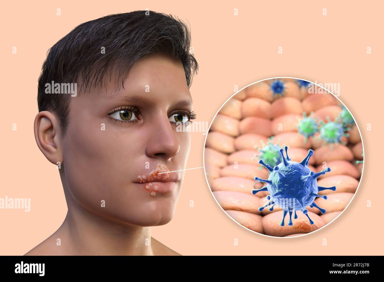 Cold sore on the lip of a man and closeup view of herpes simplex ...