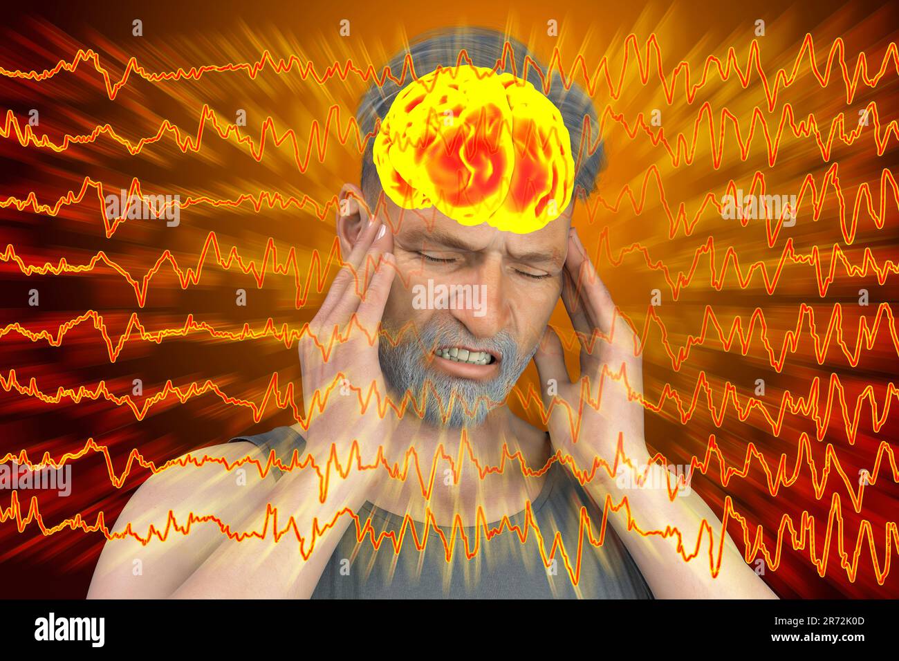 Headache, migraine, computer illustration Stock Photo - Alamy