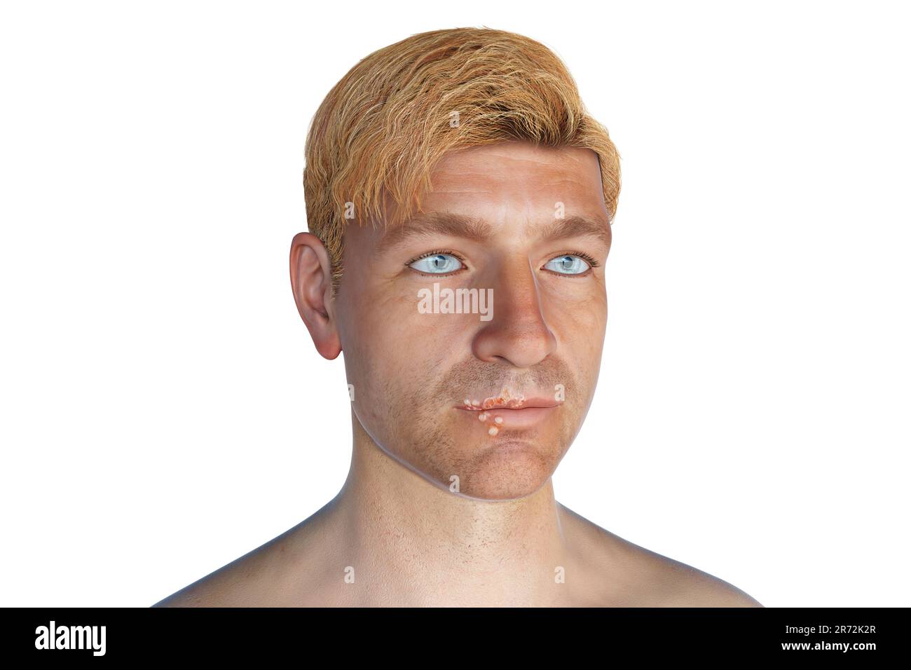 Herpes labialis, also known as cold sores, 3D illustration showing ...