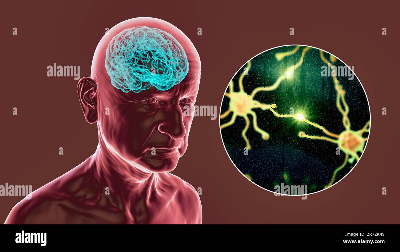 Dementia, conceptual computer illustration showing an elderly person ...