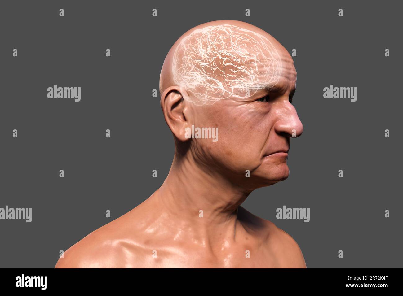 Dementia, conceptual 3D illustration showing an elderly person with ...