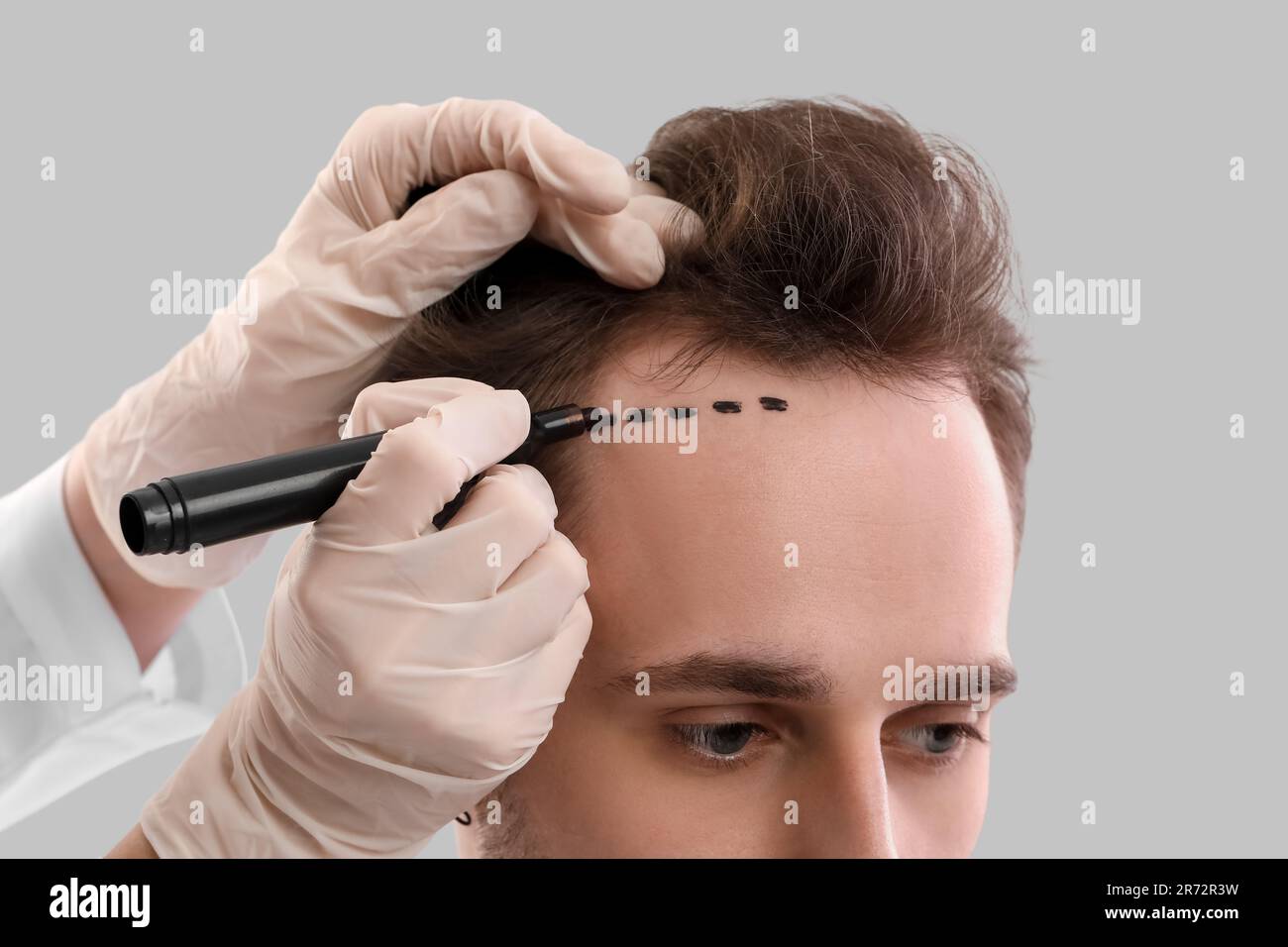 Doctor marking young man's forehead with hair loss problem on grey ...