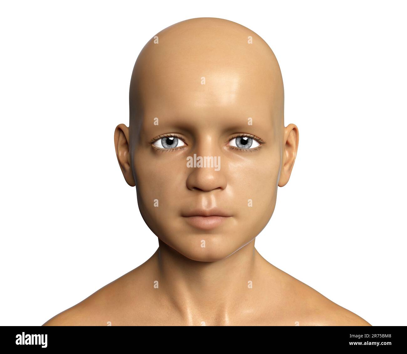 A child with alopecia, computer illustration of a boy without hair and ...