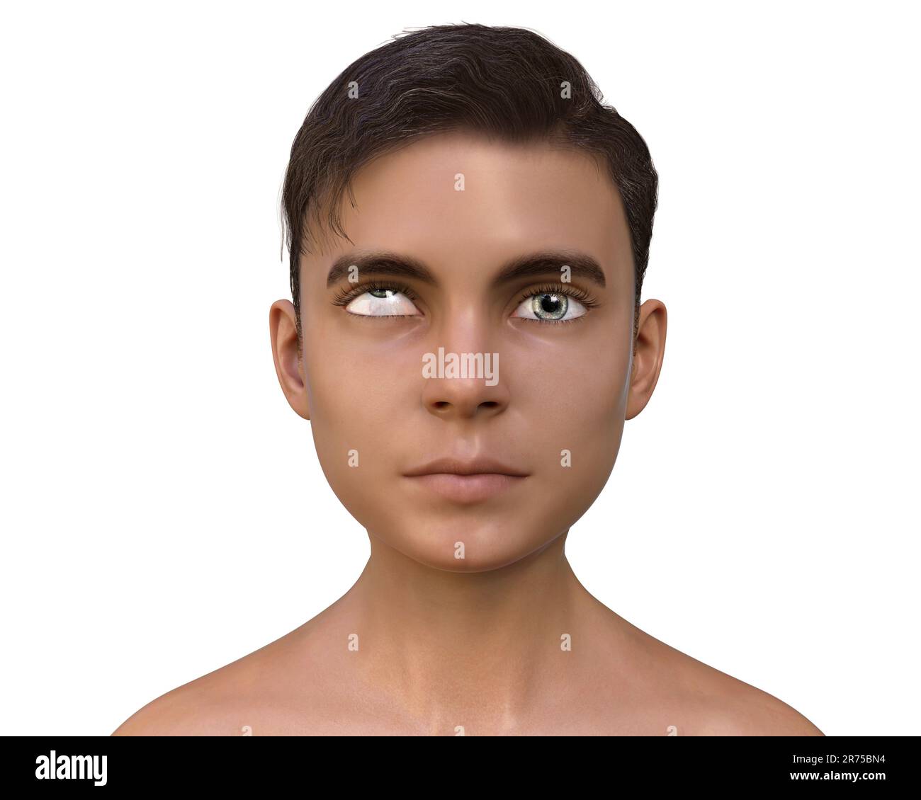 Illustration of hypertropia, a form of vertical strabismus where there ...
