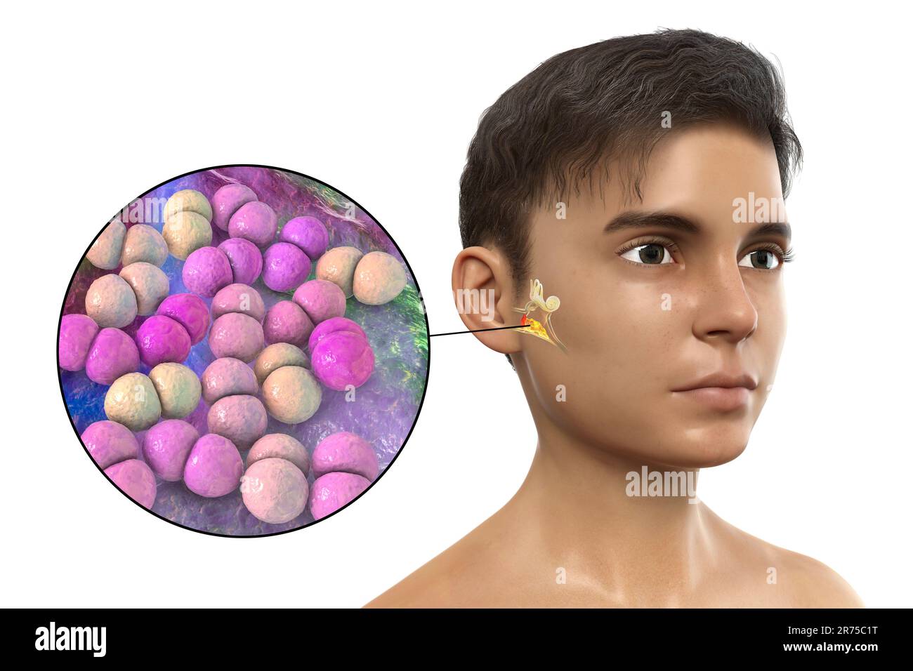 Otitis media ear infection caused by Streptococcus pneumoniae bacteria ...