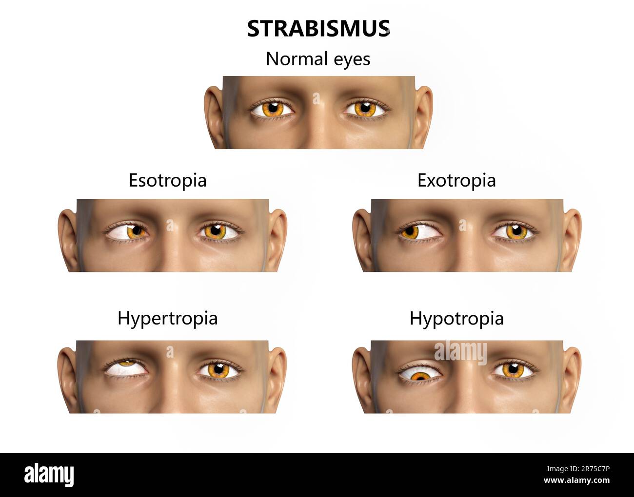 Childhood strabismus types, computer illustration Stock Photo - Alamy Childhood strabismus types, computer illustration Stock Photo - Alamy