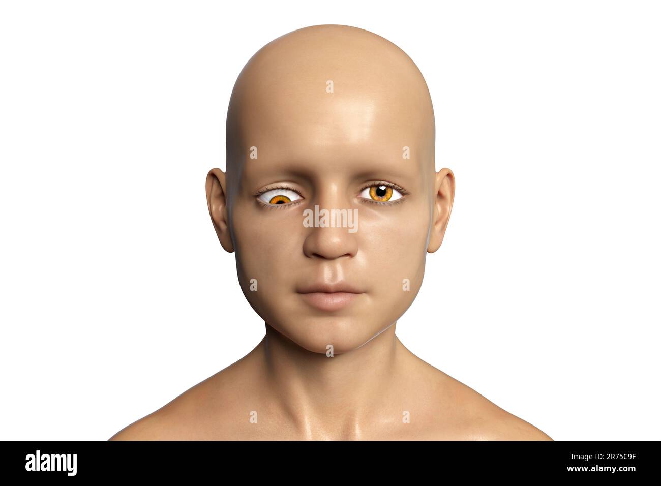 Illustration of hypotropia, a form of vertical strabismus where there ...