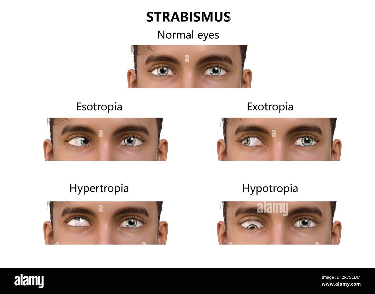 Childhood strabismus types, computer illustration Stock Photo - Alamy Childhood strabismus types, computer illustration Stock Photo - Alamy