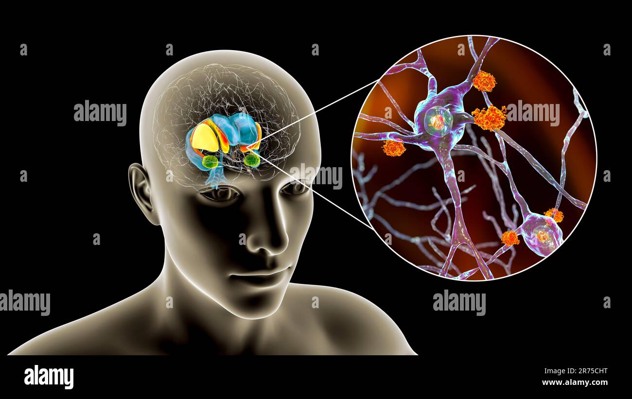 Dorsal striatum and lateral ventricles in the brain of a person with ...