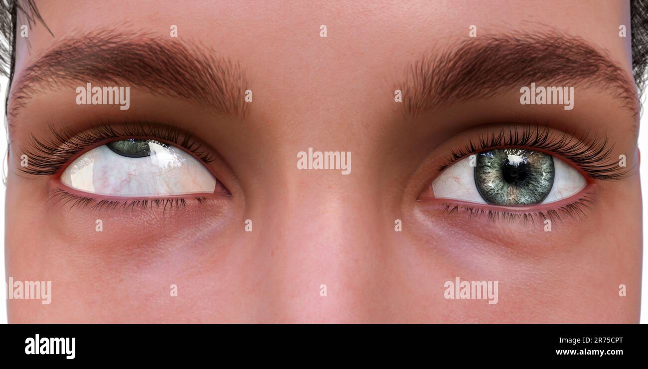Illustration of hypertropia, a form of vertical strabismus where there ...