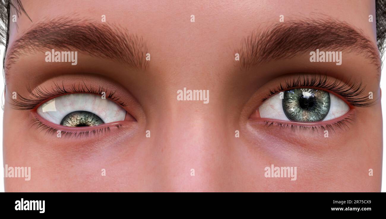 Illustration of hypotropia, a form of vertical strabismus where there ...