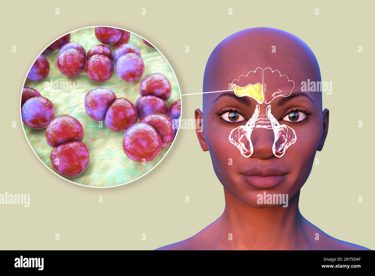 Streptococcus pneumoniae bacteria as a cause of sinusitis. Computer ...