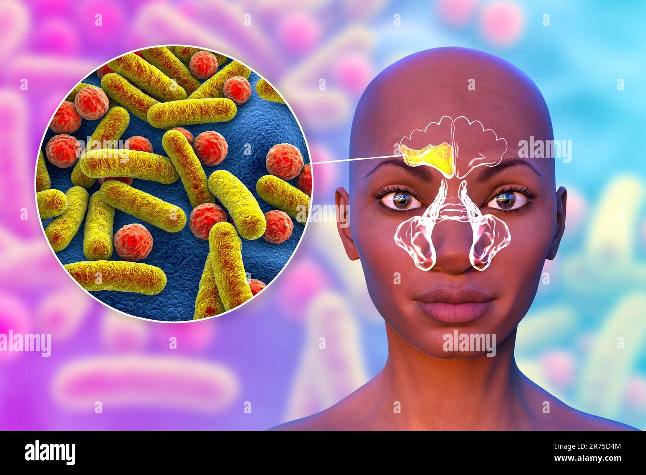Sinusitis, inflammation of paranasal cavities. Computer illustration ...