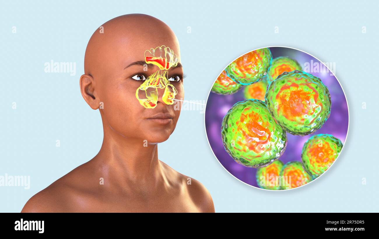 Moraxella catarrhalis bacteria as a cause of sinusitis. Computer ...