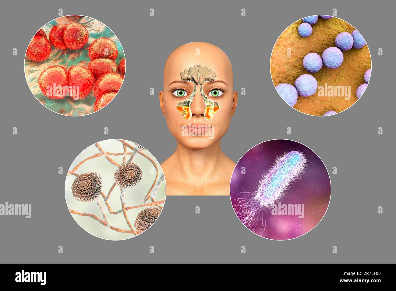 Anatomy of rhinosinusitis and microorganisms that cause sinusitis ...