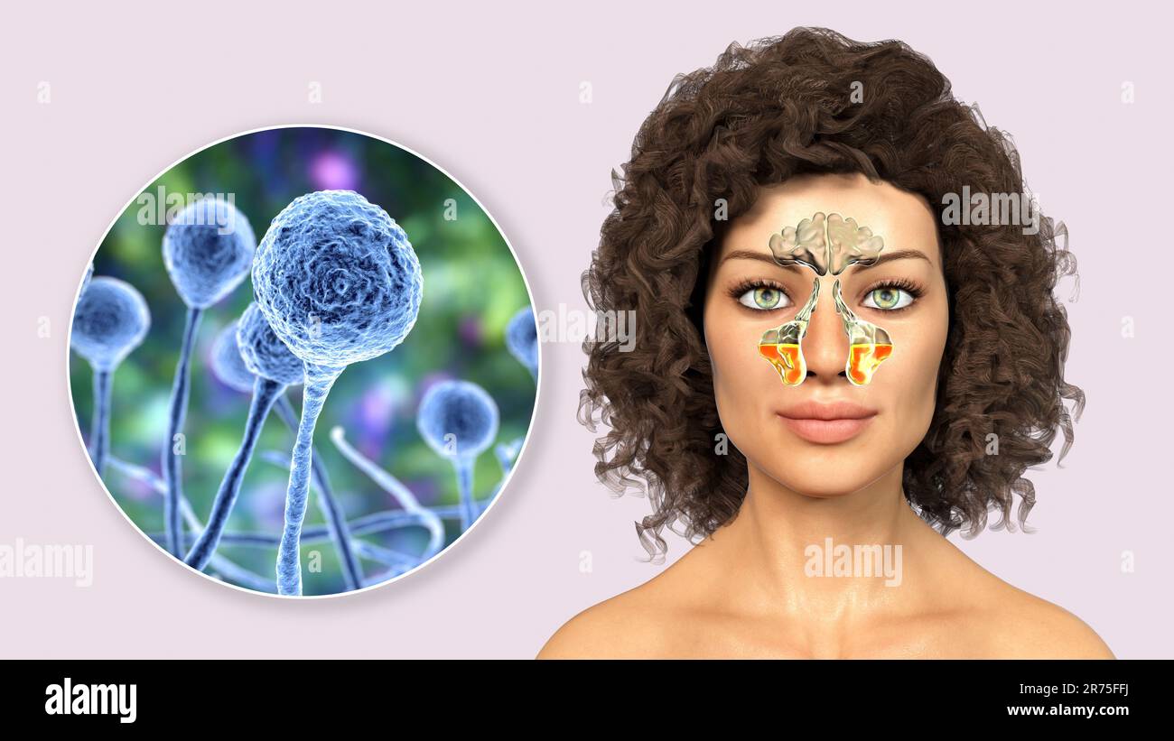 Mucor mold fungi as a cause of sinusitis. Computer illustration showing ...