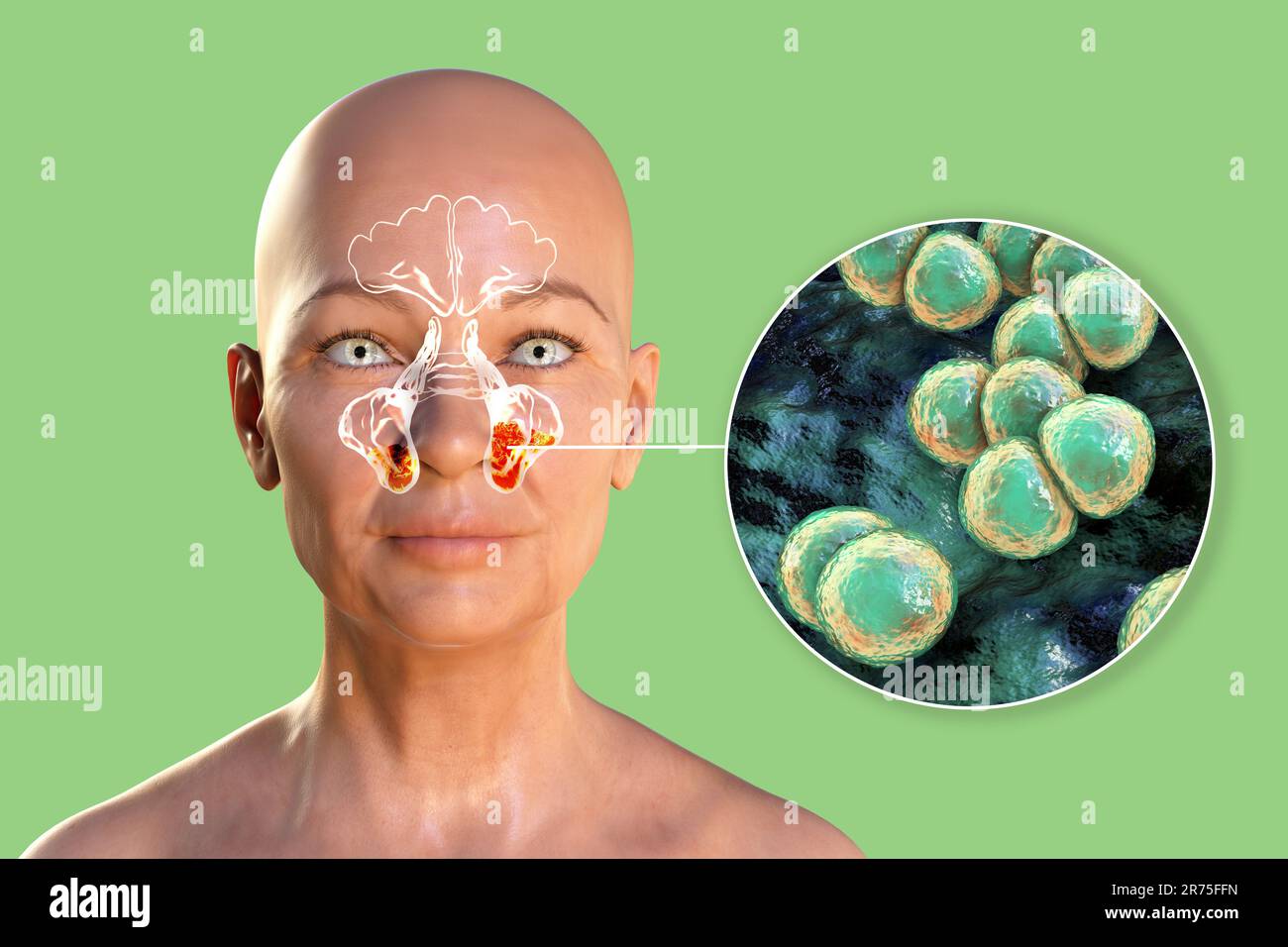 Streptococcus pneumoniae bacteria as a cause of sinusitis. Computer ...
