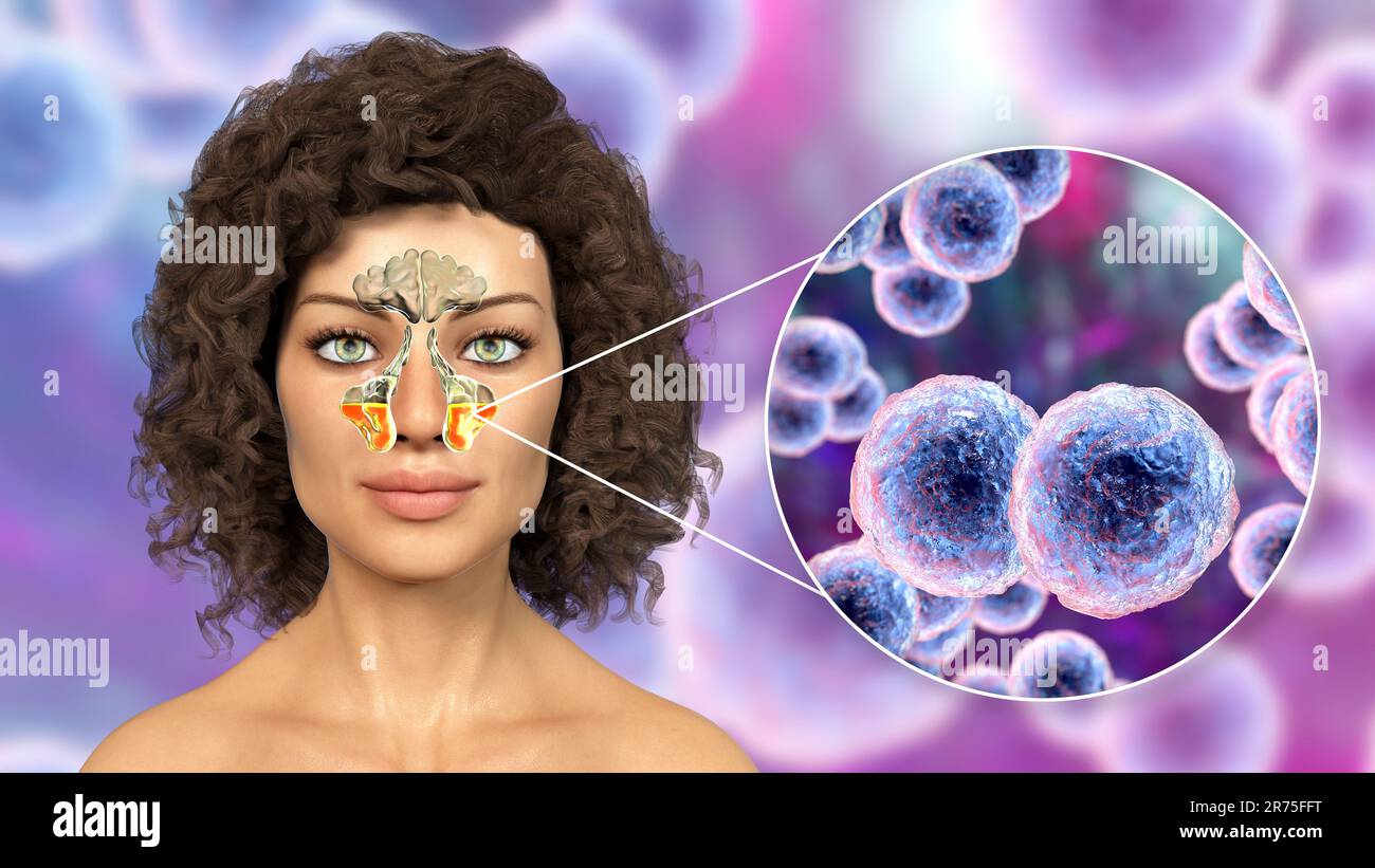 Moraxella catarrhalis bacteria as a cause of sinusitis. Computer ...