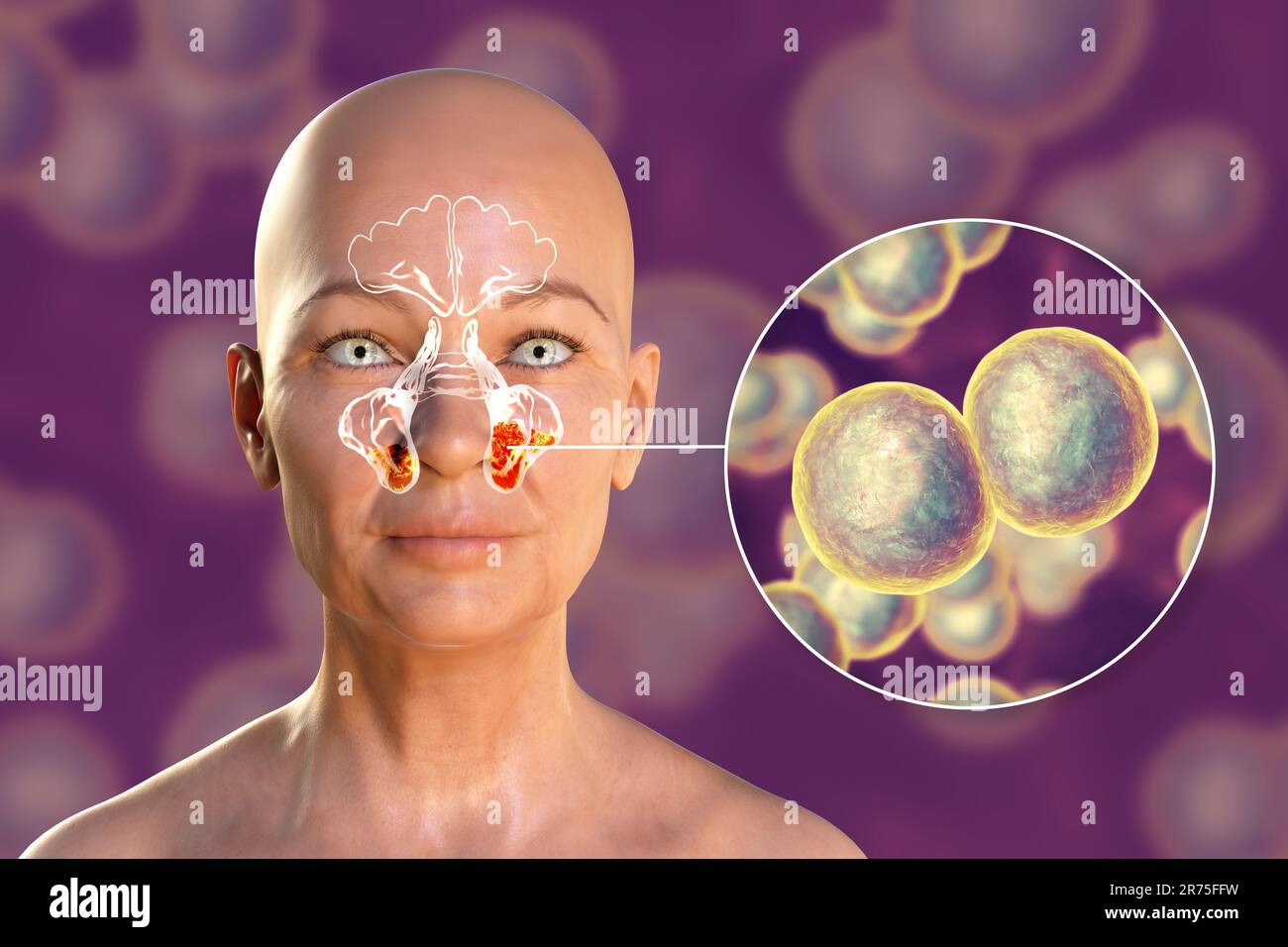 Moraxella catarrhalis bacteria as a cause of sinusitis. Computer ...