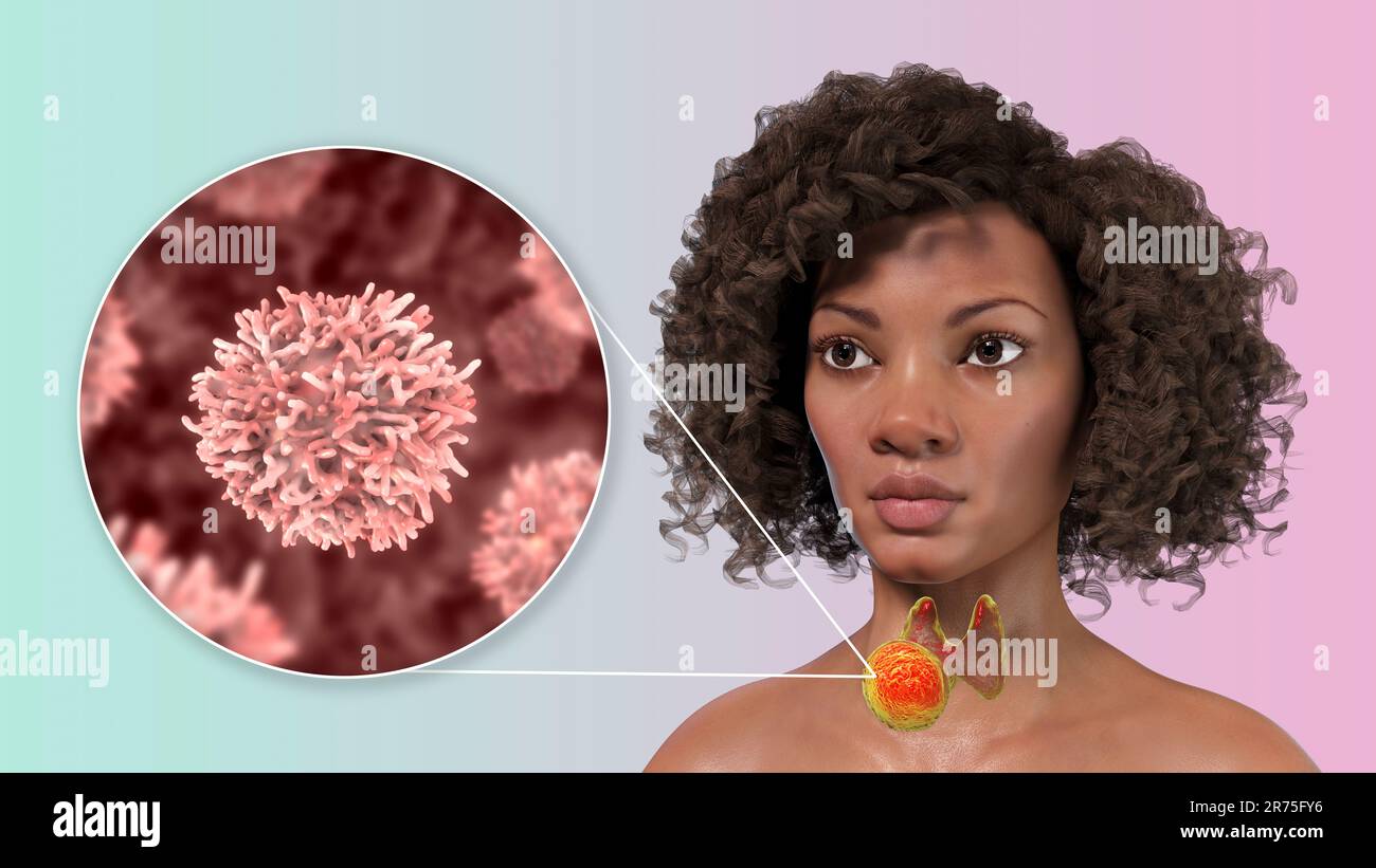 Thyroid gland cancer with closeup view of cancer cells, computer ...