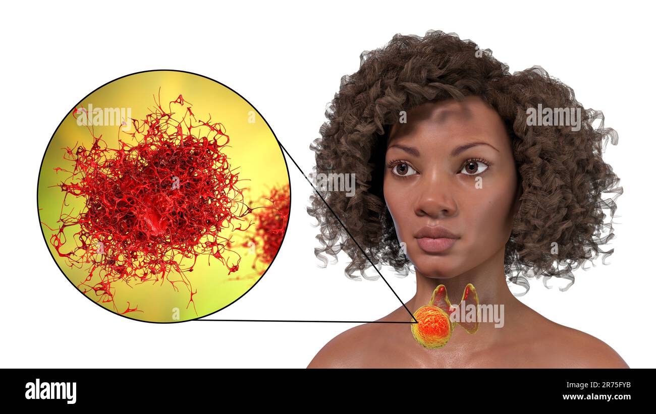 Thyroid gland cancer with closeup view of cancer cells, computer ...