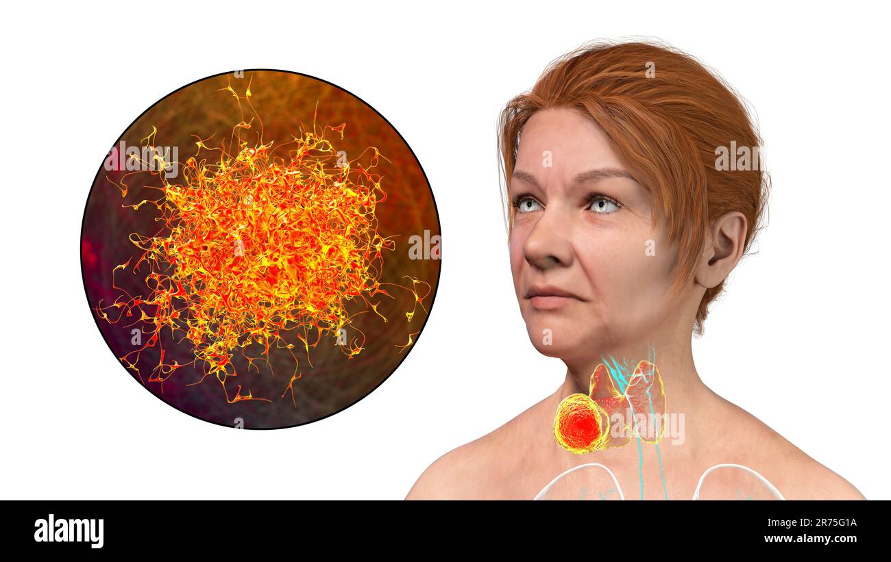 Thyroid gland cancer with closeup view of cancer cells, computer ...