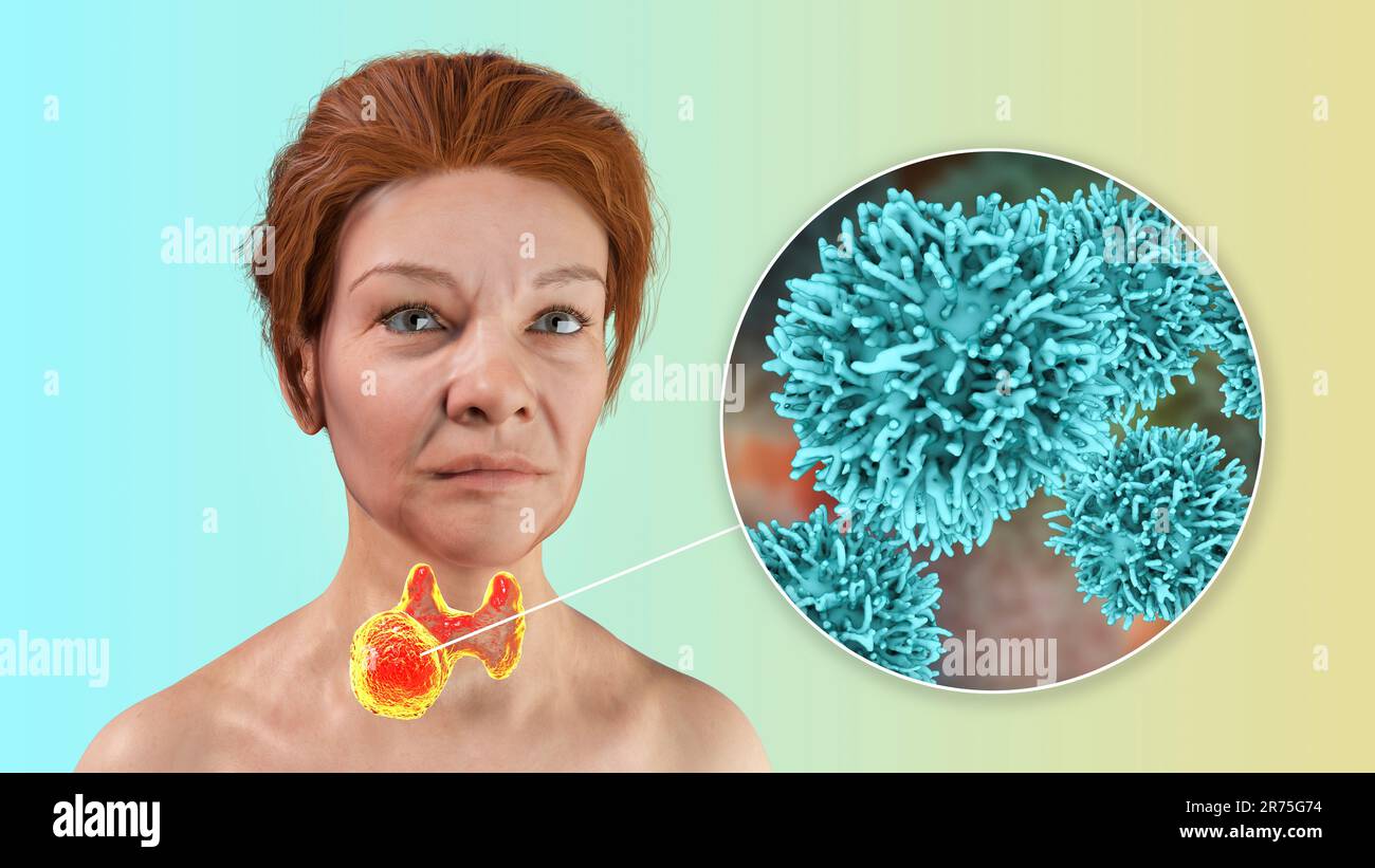 Thyroid gland cancer with closeup view of cancer cells, computer ...