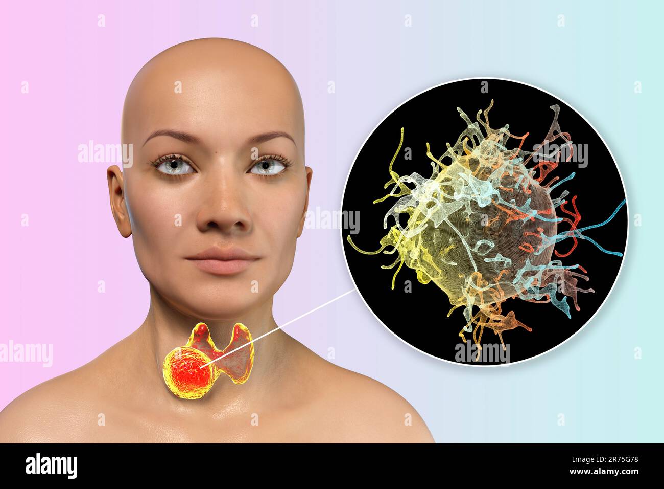 Thyroid gland cancer with closeup view of cancer cells, computer ...