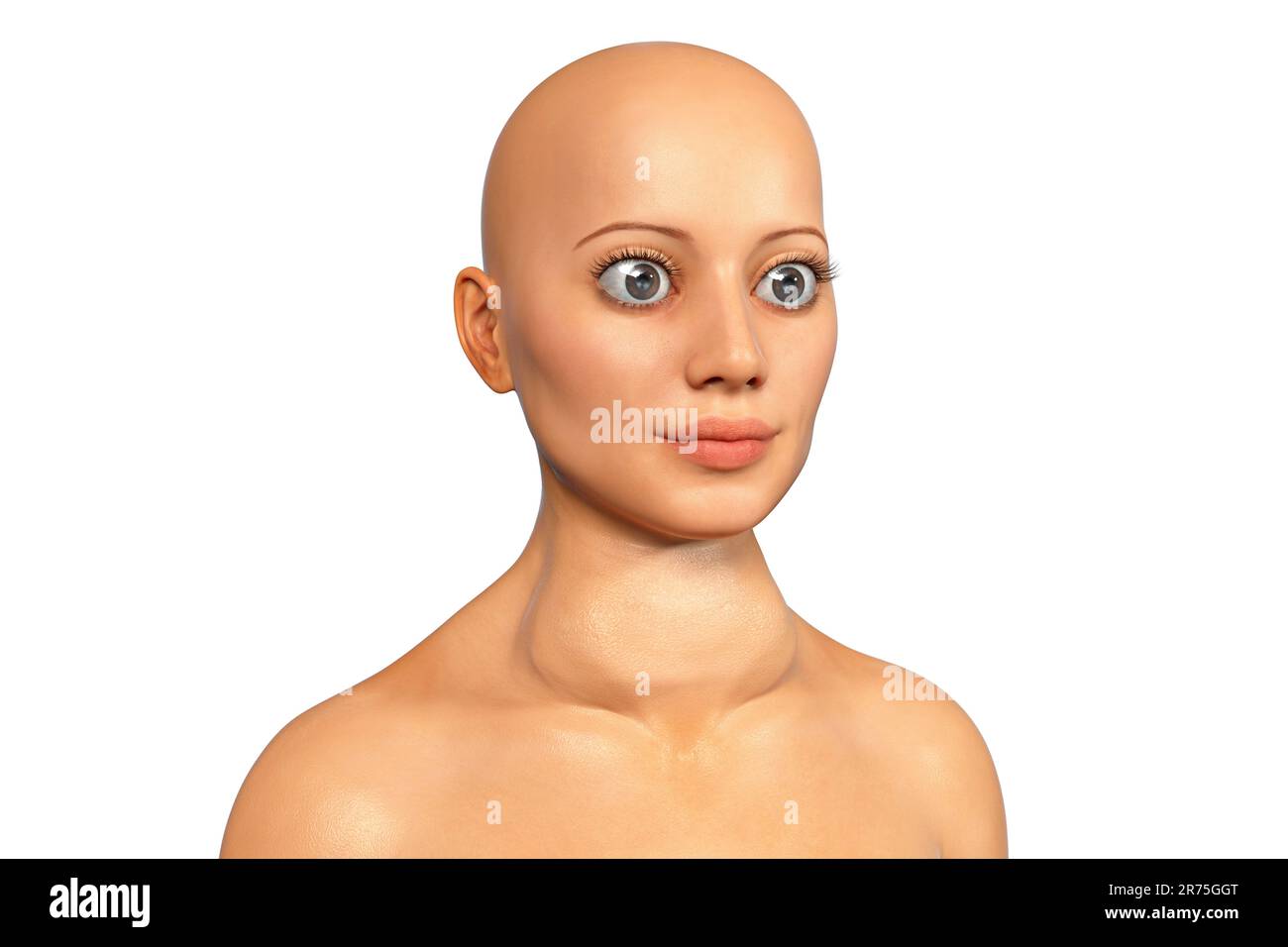 Thyrotoxic Goitre Goitre Illustration Goitre Swollen Neck Seen On