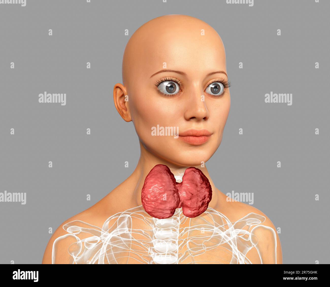 Thyrotoxic Goitre Goitre Illustration Goitre Swollen Neck Seen On
