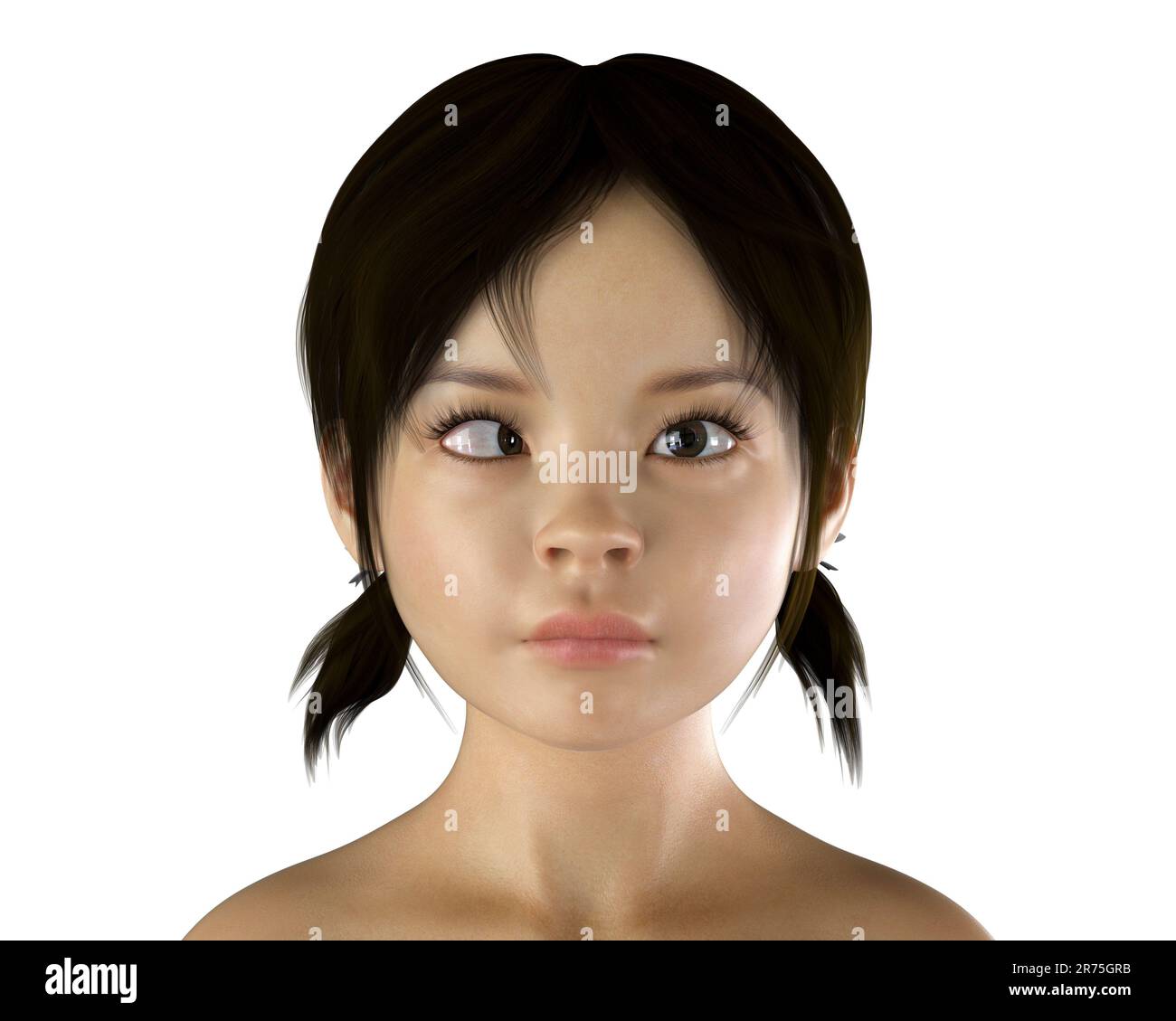 Illustration of esotropia, a form of strabismus where one or both eyes ...