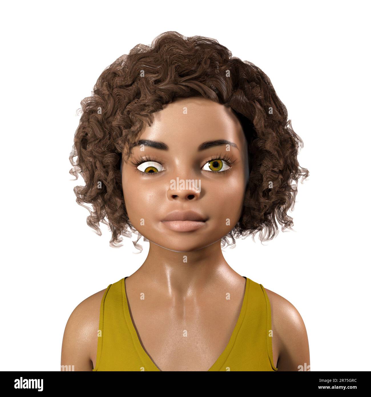 Illustration of hypotropia, a form of vertical strabismus where there ...