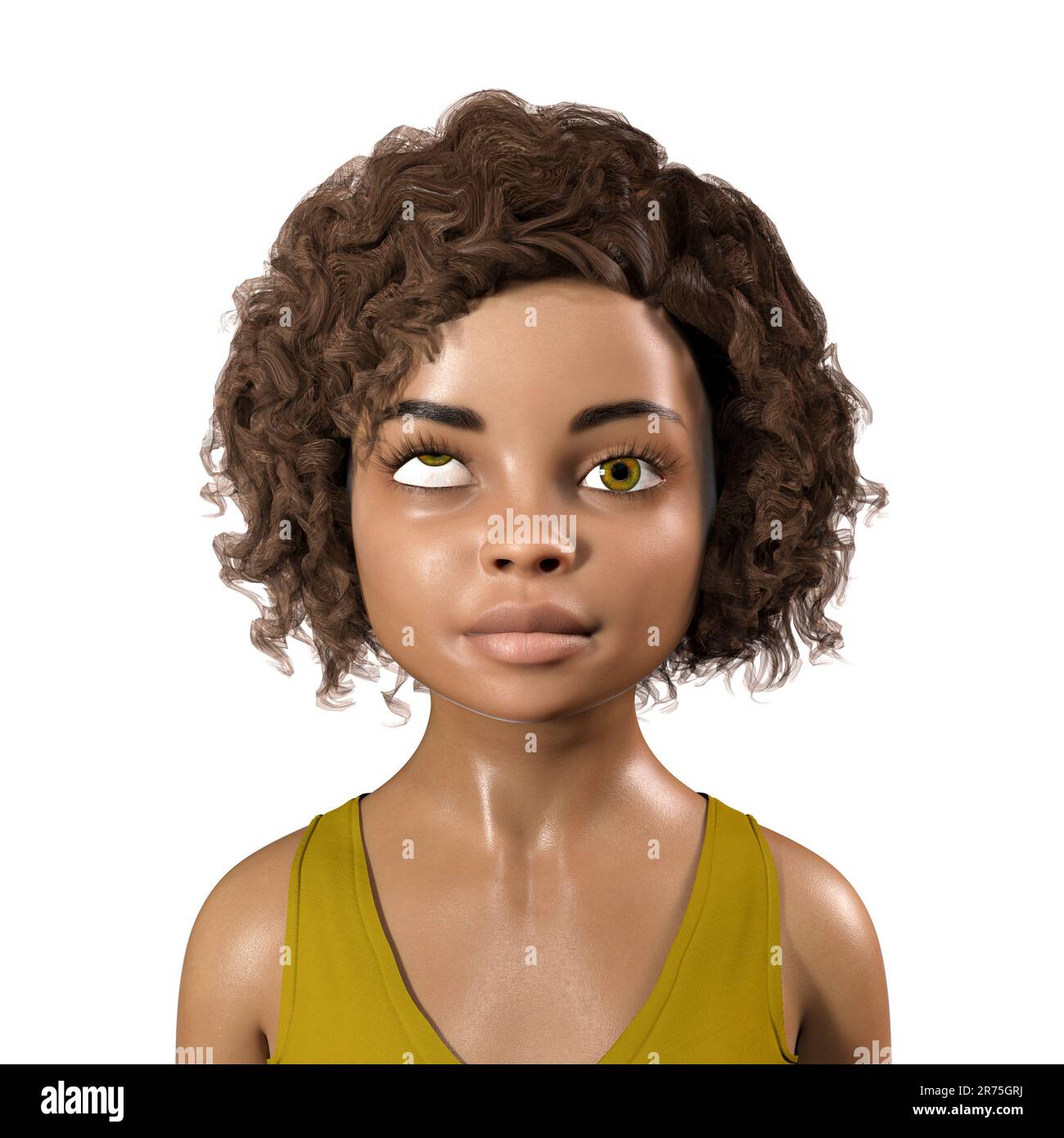 Illustration of hypertropia, a form of vertical strabismus where there ...