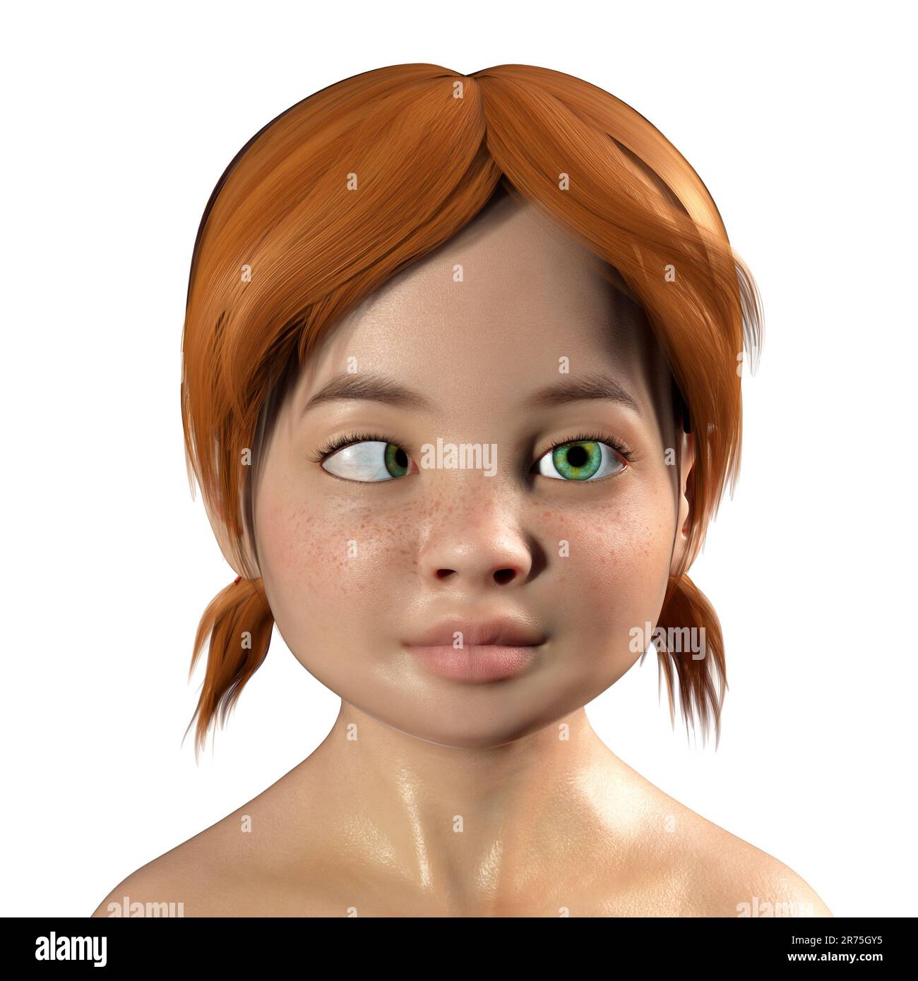 Illustration of esotropia, a form of strabismus where one or both eyes ...