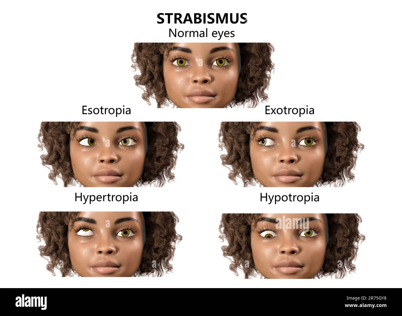 Childhood strabismus types, computer illustration Stock Photo - Alamy Childhood strabismus types, computer illustration Stock Photo - Alamy