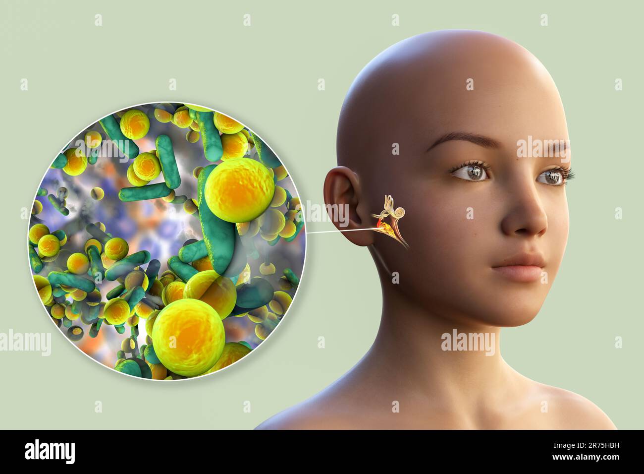Otitis media, a group of inflammatory diseases of the middle ear ...