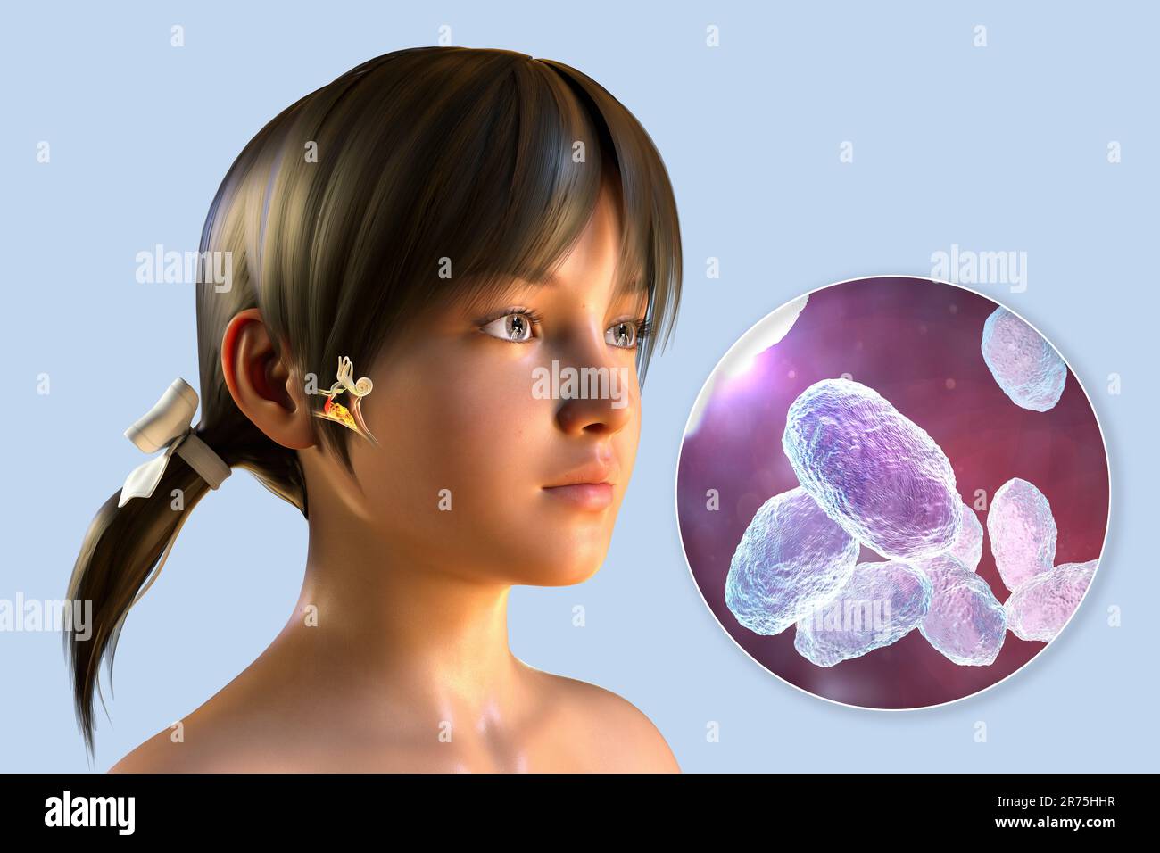 Haemophilus Influenzae Ear Infection Treatment at Caleb Aitken blog