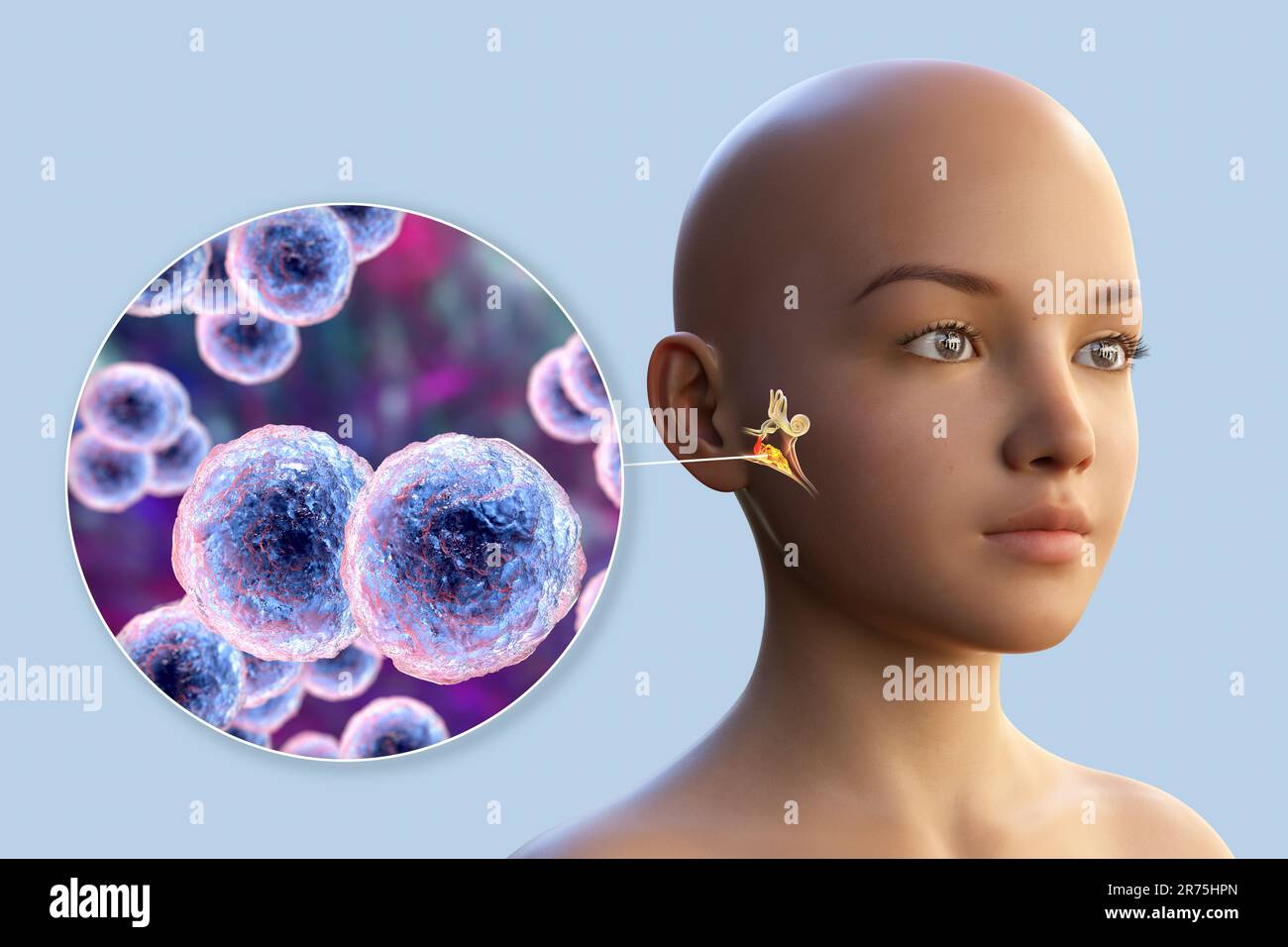 Otitis media ear infection caused by Moraxella catarrhalis bacteria ...
