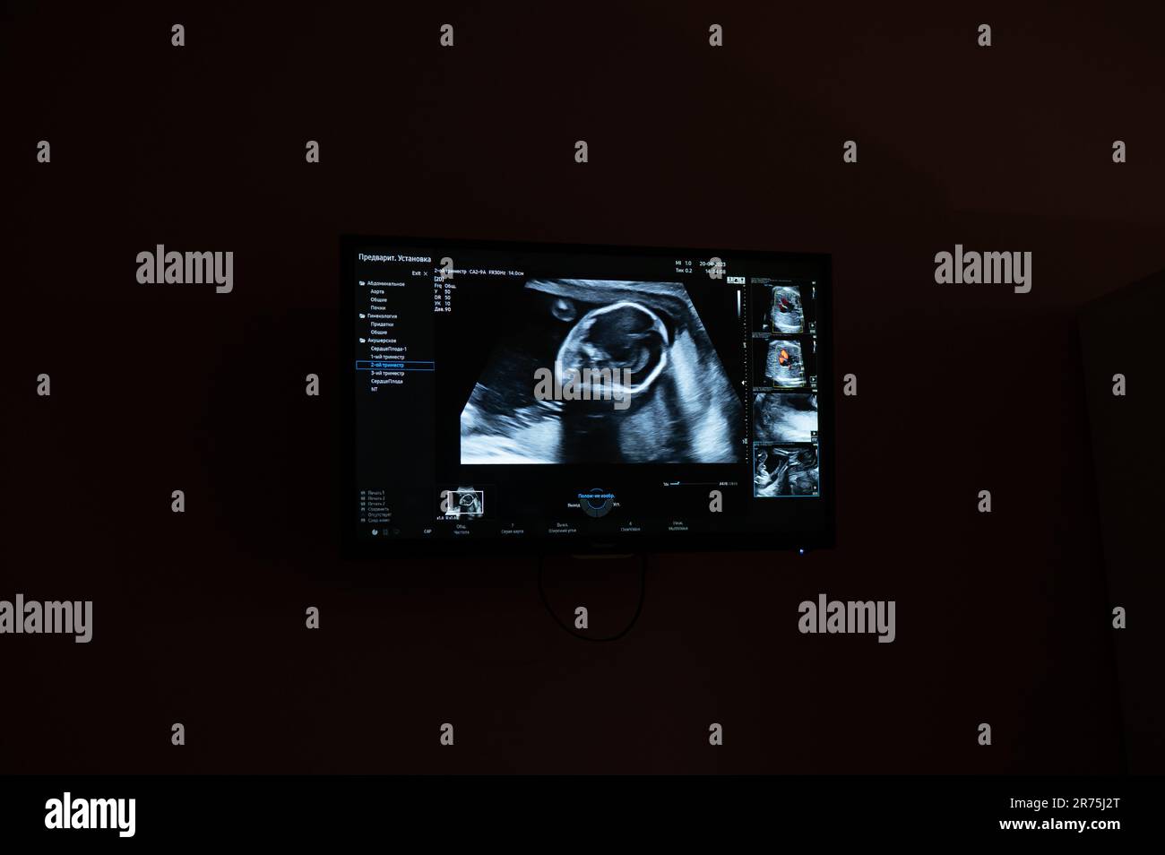 Screen shot of a second trimester prenatal screening Stock Photo - Alamy
