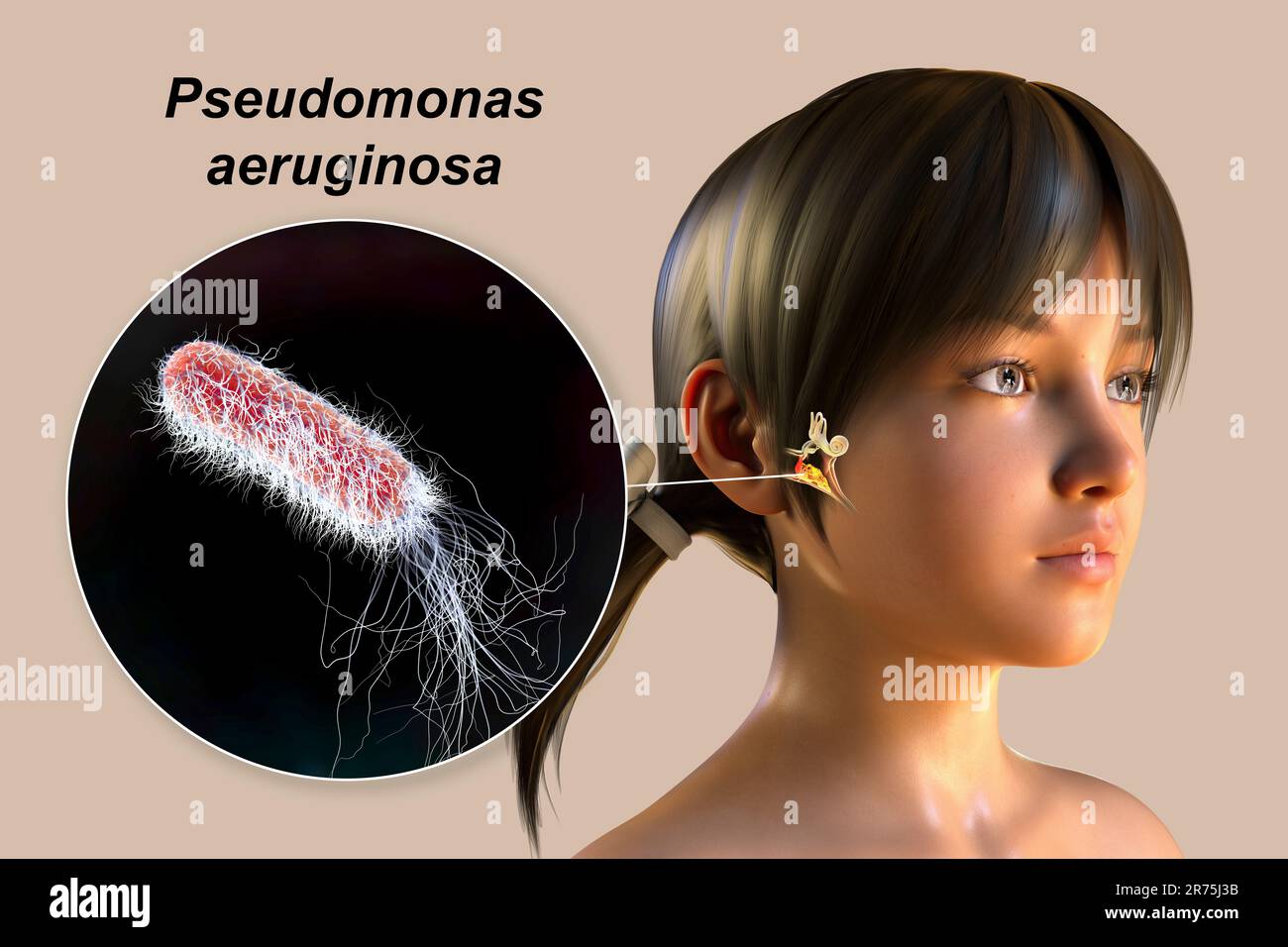 Pseudomonas Aeruginosa Ear Infection Pseudomonas Aeruginosa Ear Infection